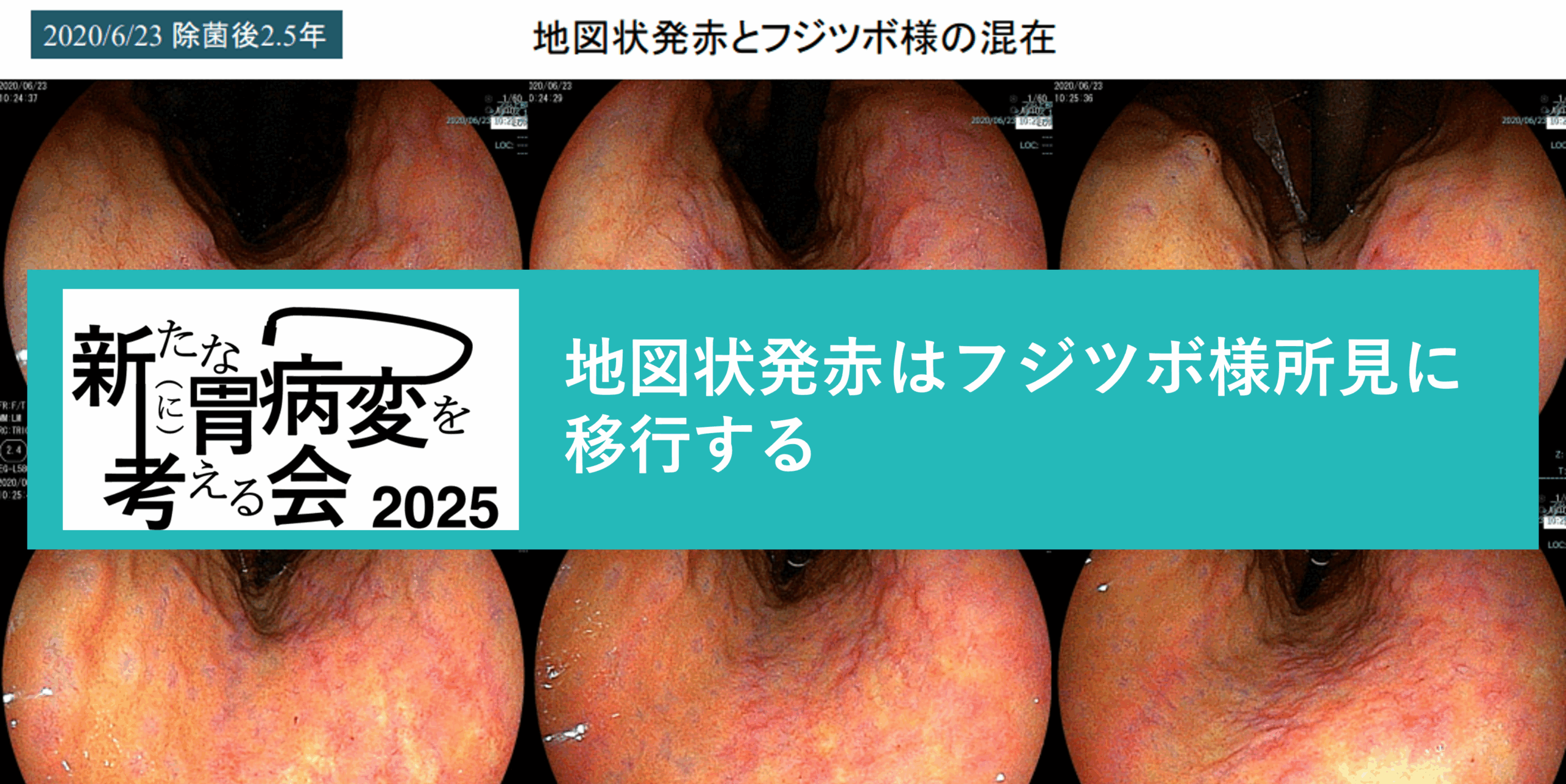 地図状発赤はフジツボ様所見に移行する【期間限定オンデマンド配信】 - ガストロAI media